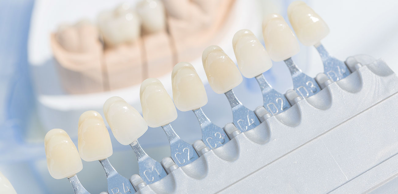 Couronnes dentaires, types, avantages et installation